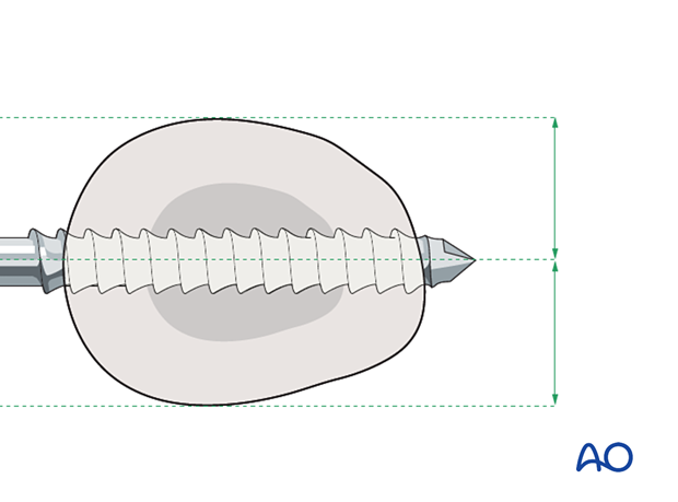 Circular or hybrid external skeletal fixator for Complex fracture of ...