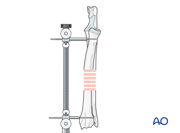 Linear external skeletal fixator for Segmental fracture of the ...