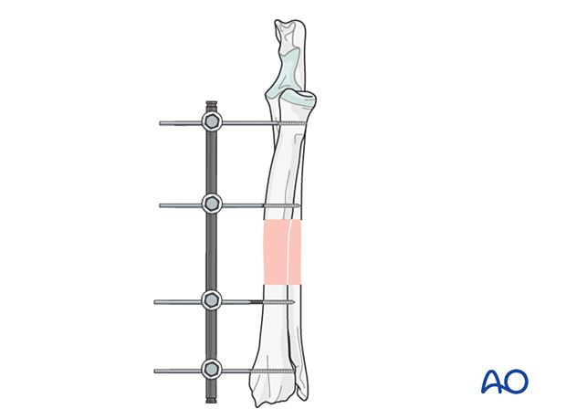Linear external skeletal fixator for Complex fracture of the diaphyseal ...