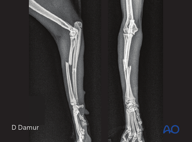 Simple fracture of the proximal zone of the diaphyseal radius