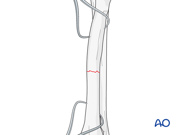 Compression plate for Incomplete fracture of the diaphyseal radius or ...