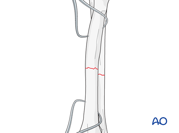 Compression plate for Simple fracture of the distal zone of the ...