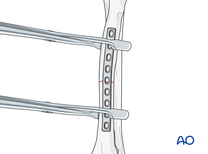 Compression plate for Incomplete fracture of the diaphyseal radius or ...