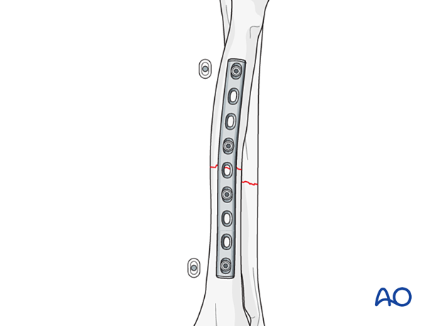 Compression plate for Simple fracture of the distal zone of the ...