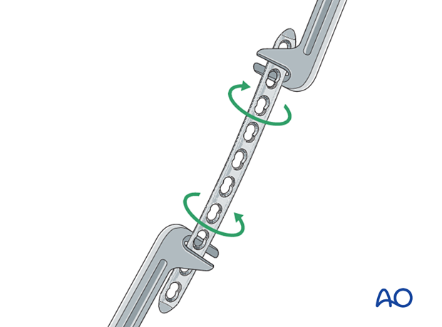 Compression plate for Simple fracture of the proximal zone of the ...