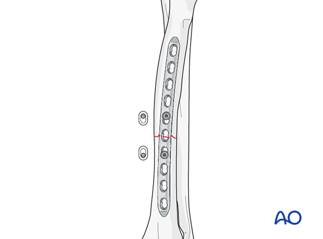 Compression plate for Incomplete fracture of the diaphyseal radius or ...