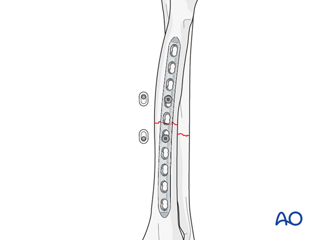 Compression plate for Simple fracture of the distal zone of the ...