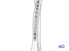 Treatment of Simple fracture of the proximal zone of the diaphyseal radius