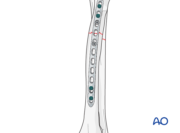 Compression plate for Simple fracture of the proximal zone of the ...