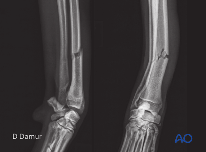 Incomplete fracture of the diaphyseal radius or fracture of one bone only