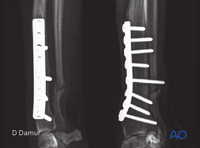 Compression plate for Simple fracture of the distal zone of the ...