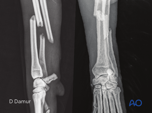 Compression plate for Simple fracture of the distal zone of the ...