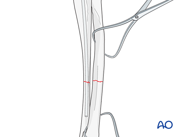 Compression plate on radius with intramedullary pin or plate on ulna ...