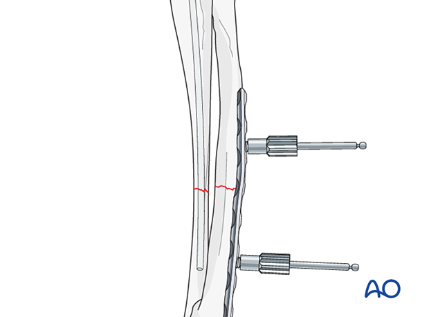 Compression plate on radius with intramedullary pin or plate on ulna ...
