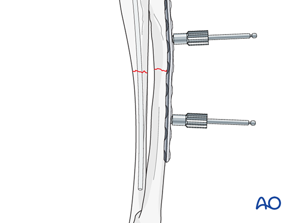 Compression plate on radius with intramedullary pin or plate on ulna ...
