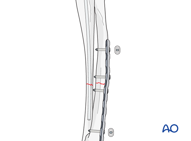 Compression plate on radius with intramedullary pin or plate on ulna ...