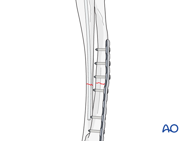 Compression plate on radius with intramedullary pin or plate on ulna ...