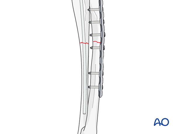 Compression plate on radius with intramedullary pin or plate on ulna ...
