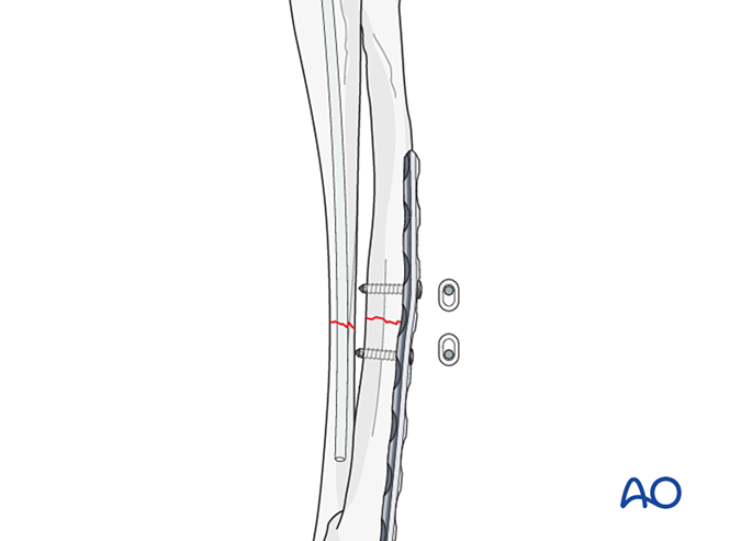 Compression plate on radius with intramedullary pin or plate on ulna ...