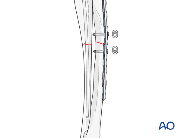 Compression plate on radius with intramedullary pin or plate on ulna ...