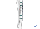 Treatment of Simple fracture of the proximal zone of the diaphyseal radius