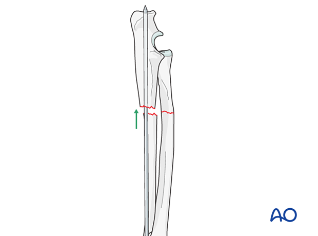 Compression plate on radius with intramedullary pin or plate on ulna ...