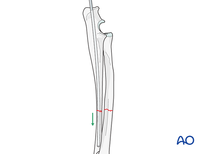 Compression plate on radius with intramedullary pin or plate on ulna ...