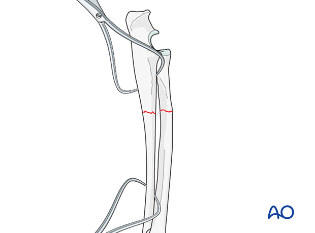 Compression plate on radius with intramedullary pin or plate on ulna ...