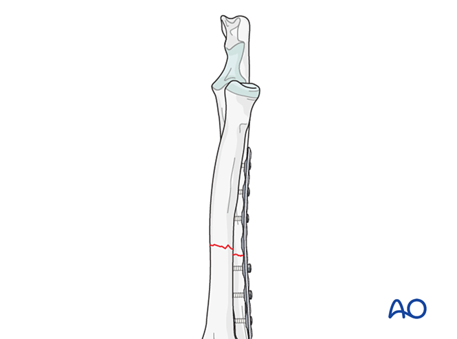 Compression plate on radius with intramedullary pin or plate on ulna ...