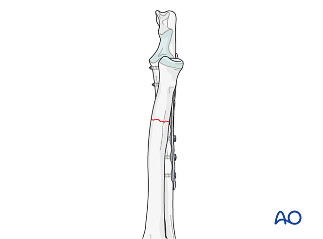 Compression plate on radius with intramedullary pin or plate on ulna ...