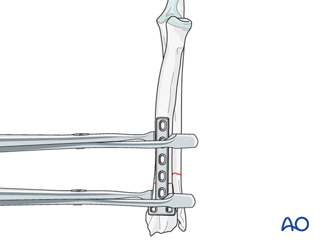 Compression T-plate for Simple fracture of the distal zone of the ...