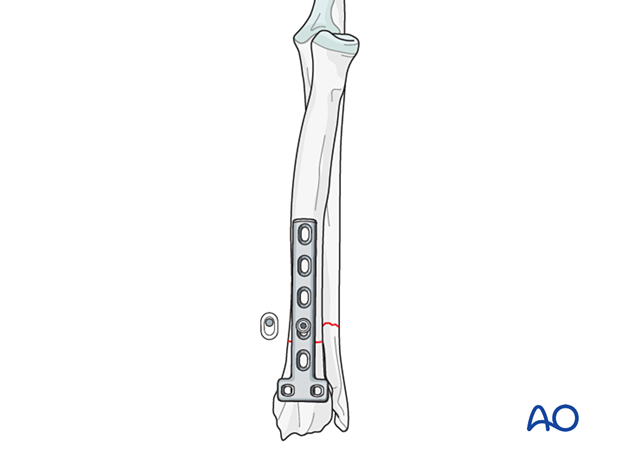 Compression T-plate for Simple fracture of the distal zone of the ...