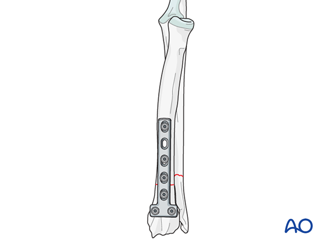 Compression T-plate for Simple fracture of the distal zone of the ...