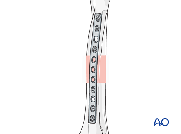 Bridging plate for Complex fracture of the diaphyseal radius with ...