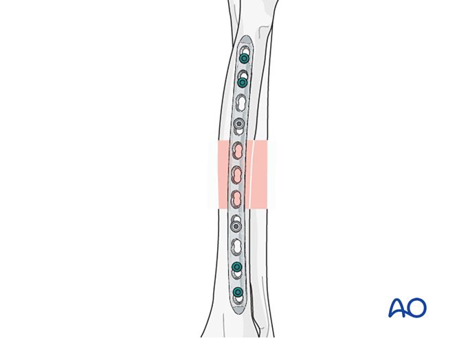 Bridging plate for Complex fracture of the diaphyseal radius with ...