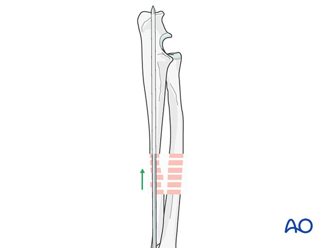 Orthogonal bridging plates on radius with intramedullary pin or plate ...