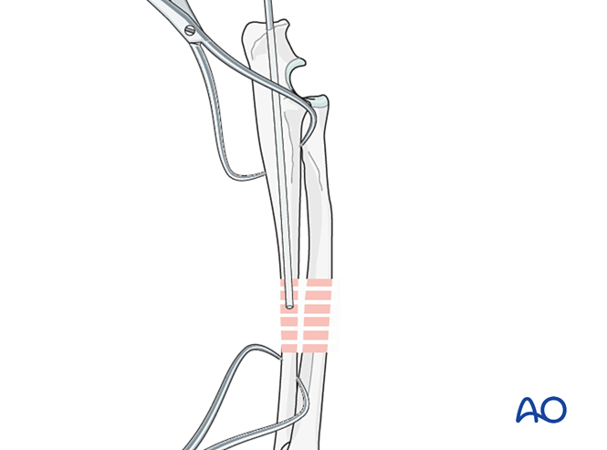 Bridging plate on radius and intramedullary pin or plate on ulna for ...