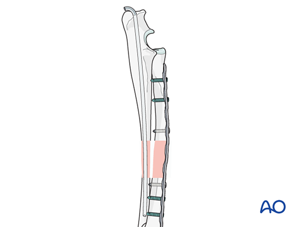 Bridging plate on radius and intramedullary pin or plate on ulna for ...