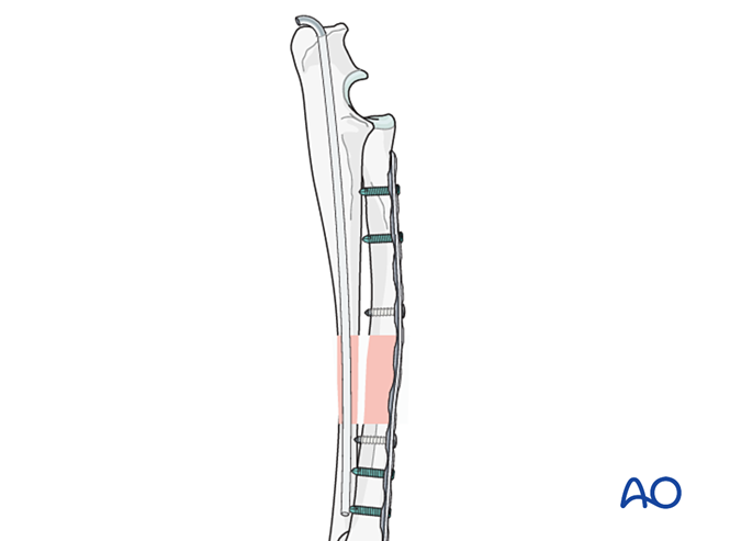 Bridging plate on radius and intramedullary pin or plate on ulna for ...
