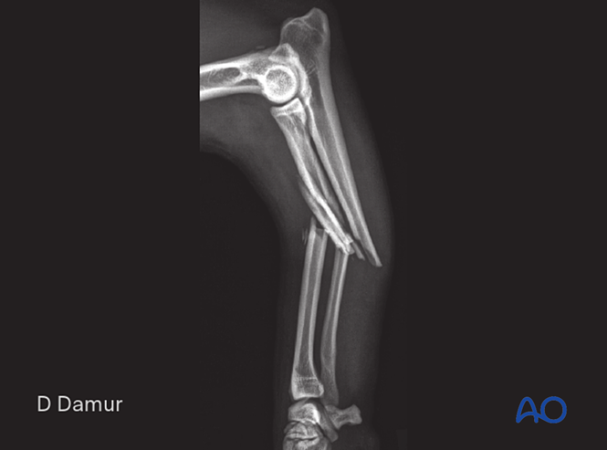 Wedge fracture of the proximal zone of the diaphyseal radius with ...
