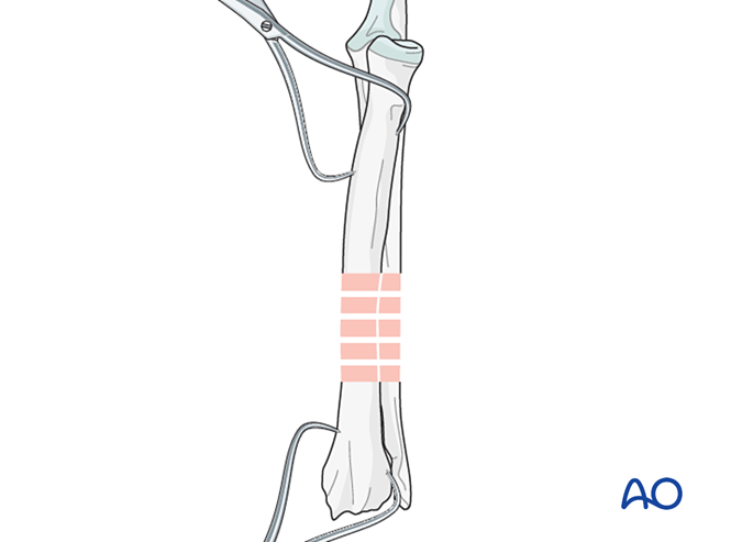 Orthogonal bridging plates for Complex fracture of the diaphyseal ...
