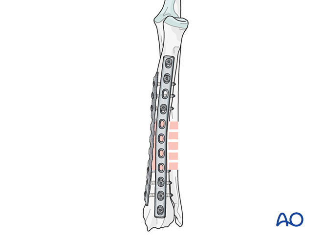 Orthogonal bridging plates for Complex fracture of the diaphyseal ...