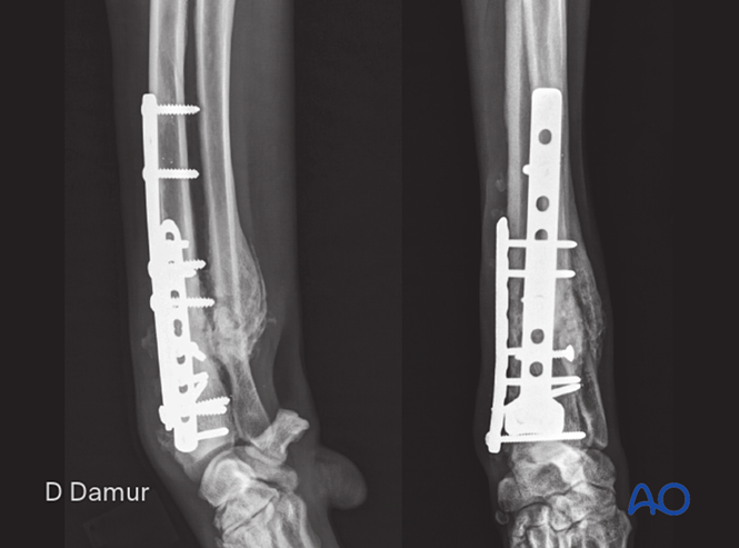 Orthogonal bridging plates for Complex fracture of the diaphyseal ...