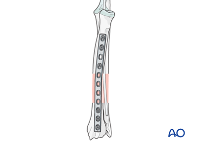 Orthogonal bridging plates on radius with intramedullary pin or plate ...