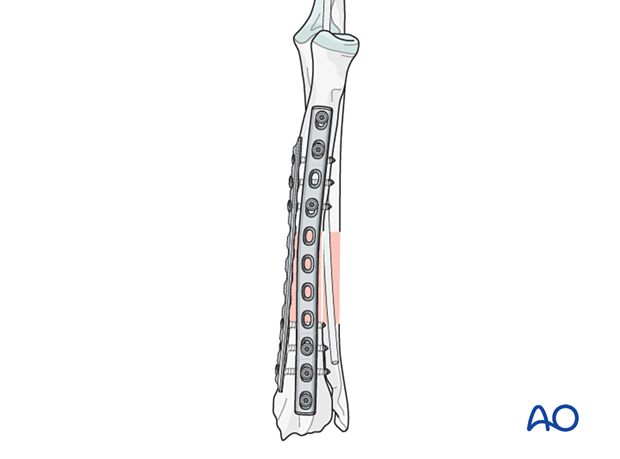 Orthogonal bridging plates on radius with intramedullary pin or plate ...