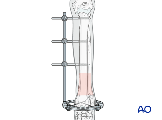Circular or hybrid external skeletal fixator for Complex fracture of ...