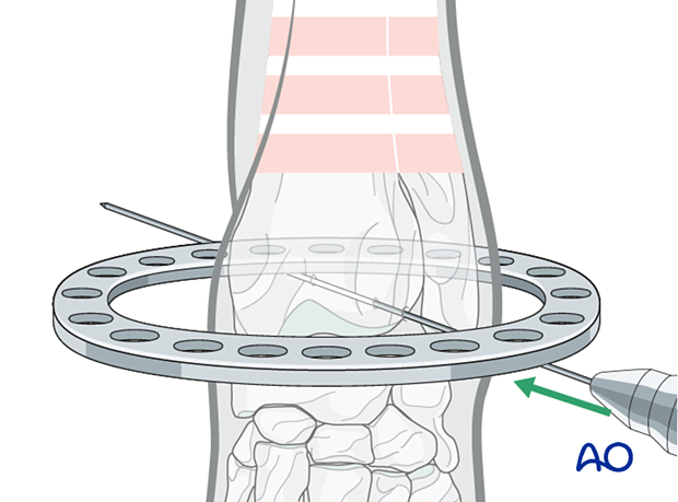 Circular or hybrid external skeletal fixator for Complex fracture of ...