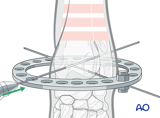 Circular or hybrid external skeletal fixator for Complex fracture of ...