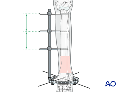 Circular or hybrid external skeletal fixator for Complex fracture of ...