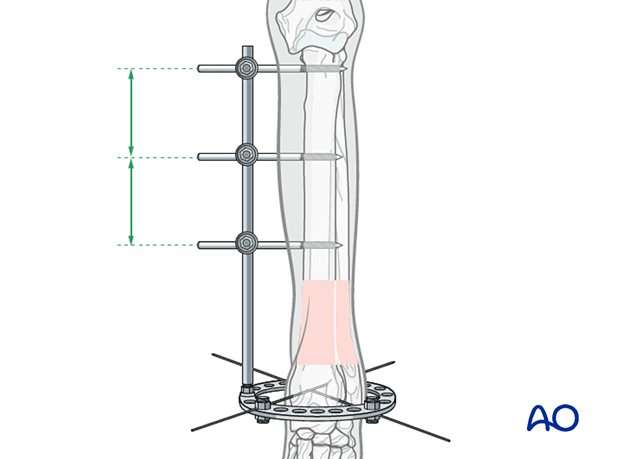 Circular or hybrid external skeletal fixator for Complex fracture of ...